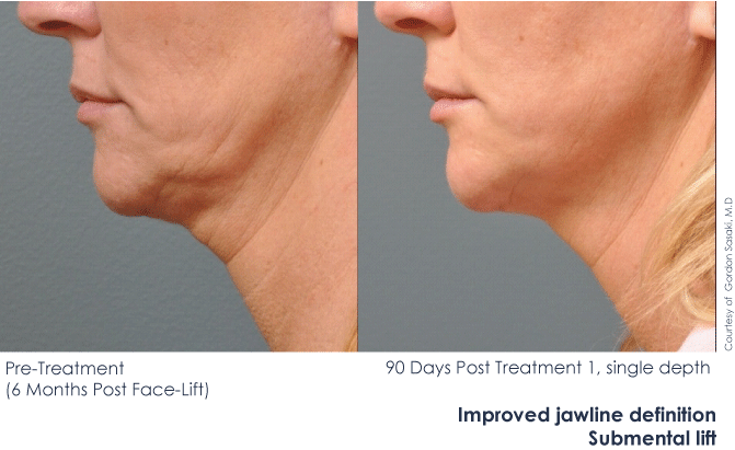 Ultherapy Skin Tightening Dr Branman