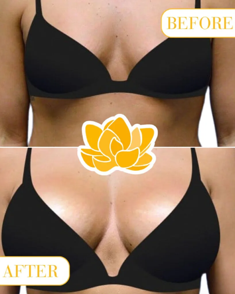 4 Things You Probably Didnt Know About Breast Augmentation What Is